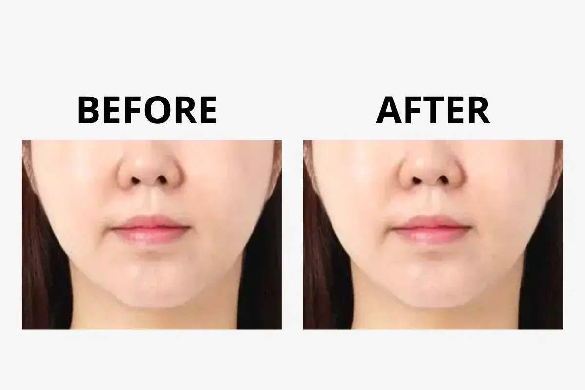 韓國「HIFU/海芙音波/韓版超聲刀」介紹&價錢-韓國（Creatrip）